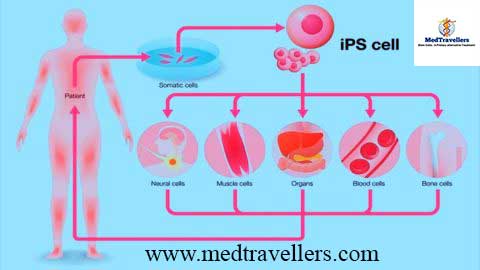 Induced Pluripotent Stem Cell