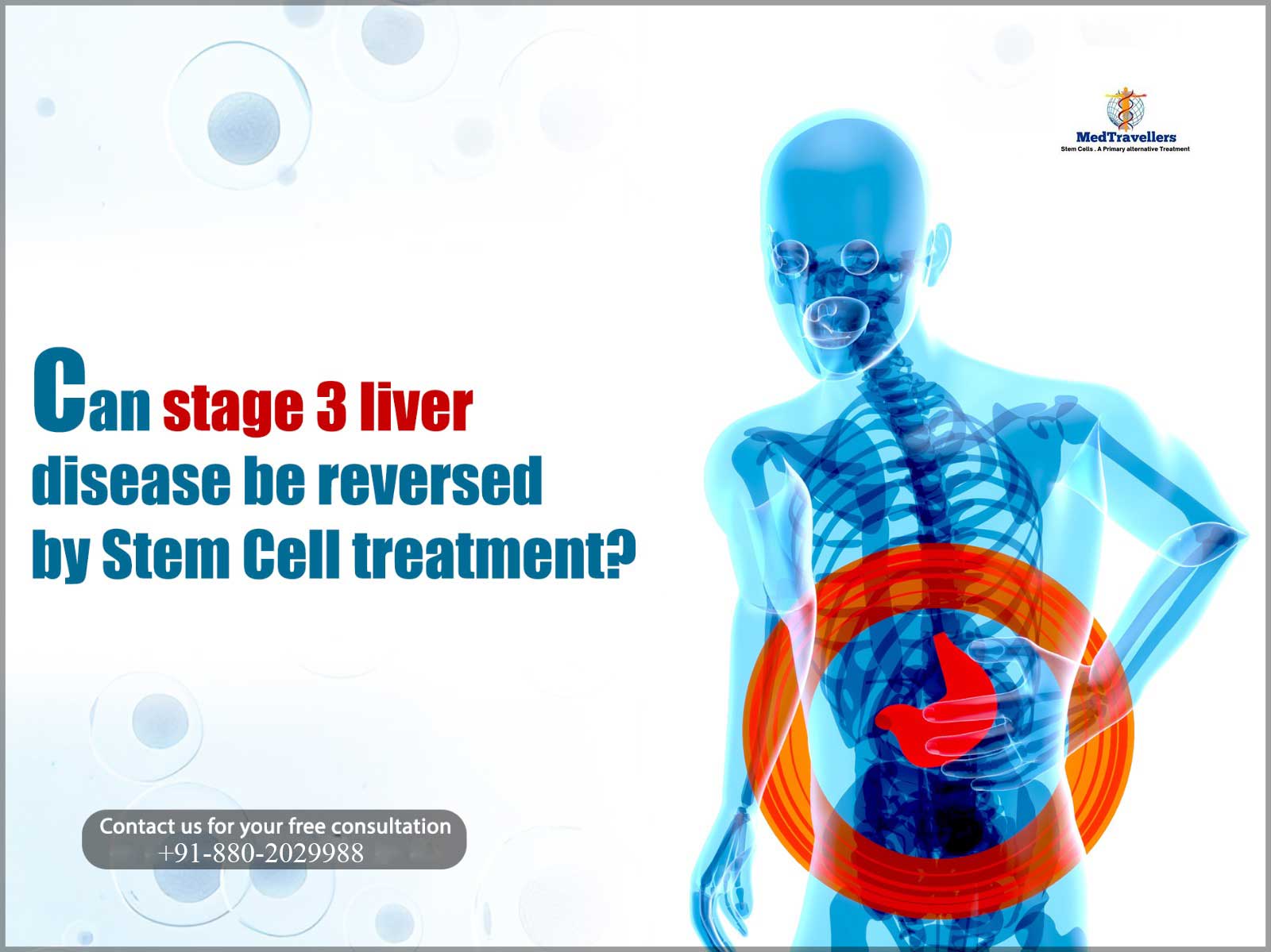 Can Stage 3 Liver Disease Be Reversed by Stem Cell Treatment?